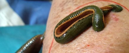 Leech Therapy / Jalaukavacharana Treatment / Hirudo Therapy | Ayurdhama ...
